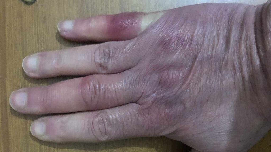 Geloni: cosa sono, come riconoscerli e i rimedi per curarli - Saluteweb.it